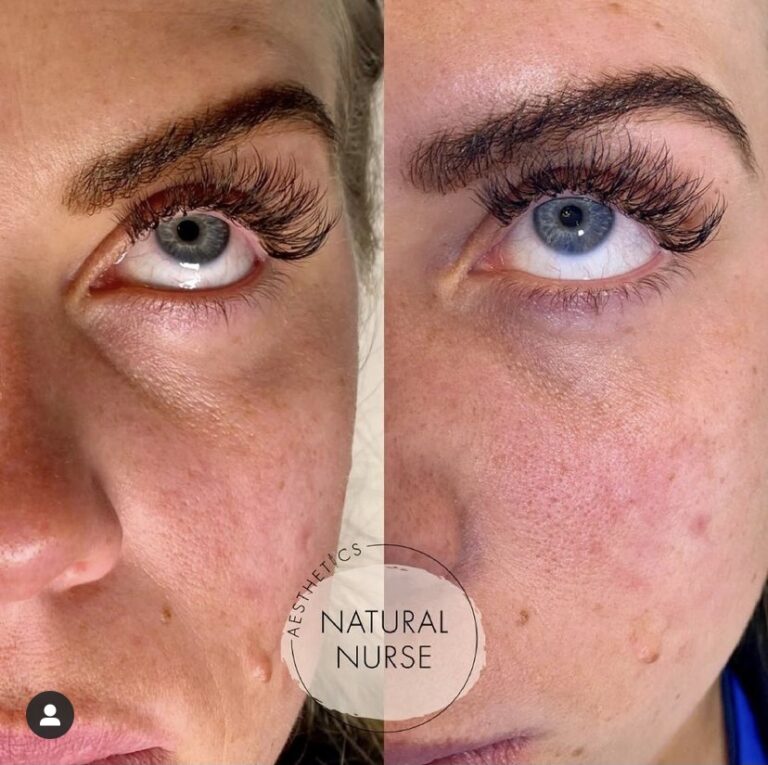 Tear Trough Treatment in Wigan - Natural Nurse Aesthetics