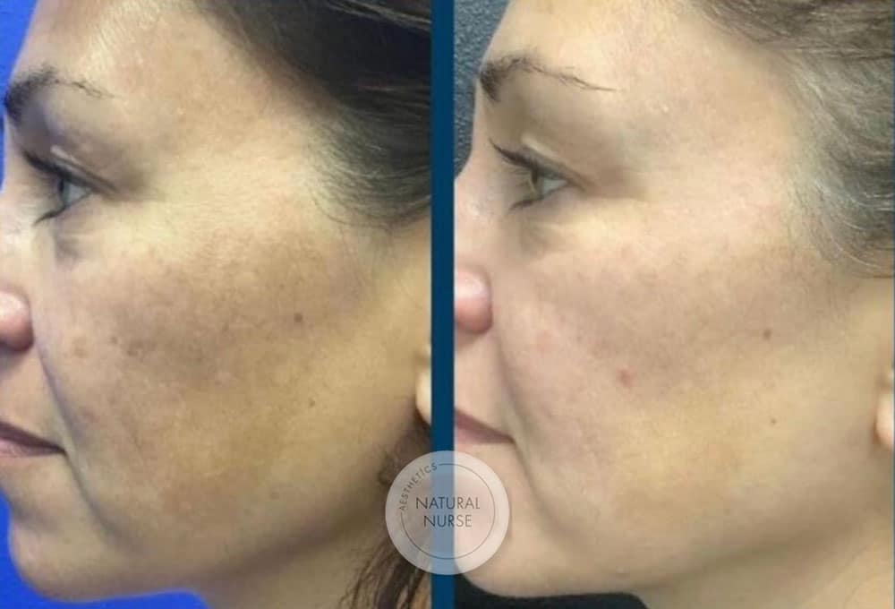 SkinPen Microneedling - Natural Nurse Aesthetics