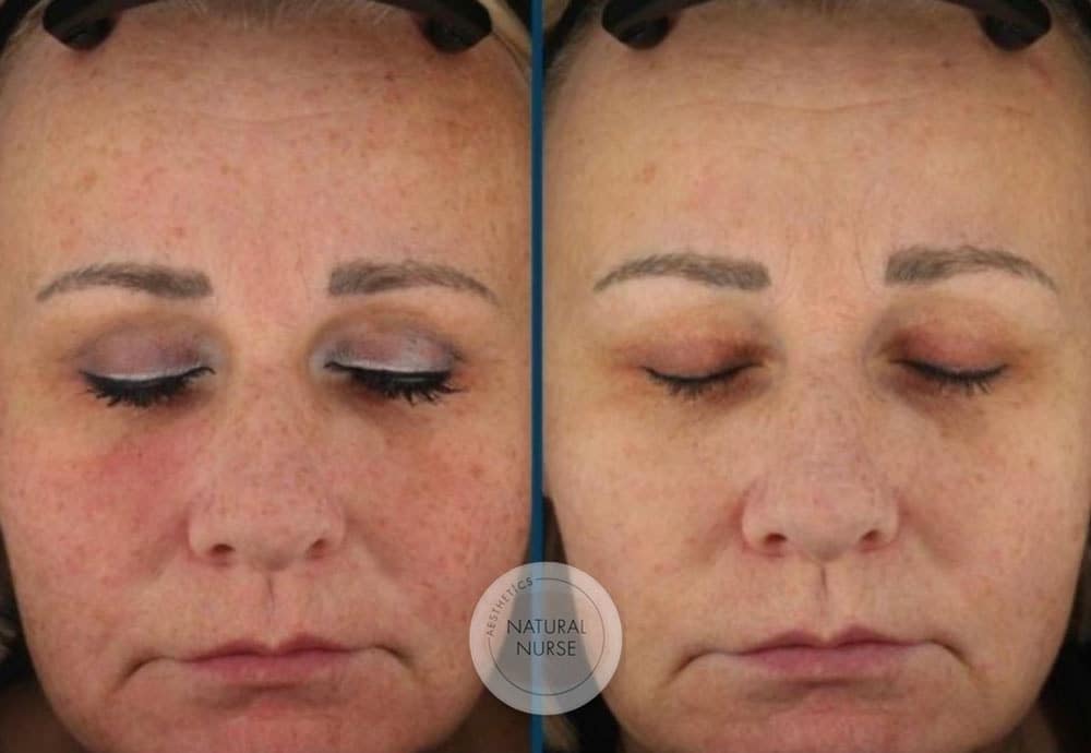 SkinPen Microneedling - Natural Nurse Aesthetics